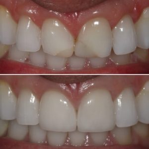 5 Things You Must Know About Veneers | Dentistry on George